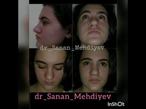 Sənan Mehdiyev . Qalin derili burunlar haqinda melumat