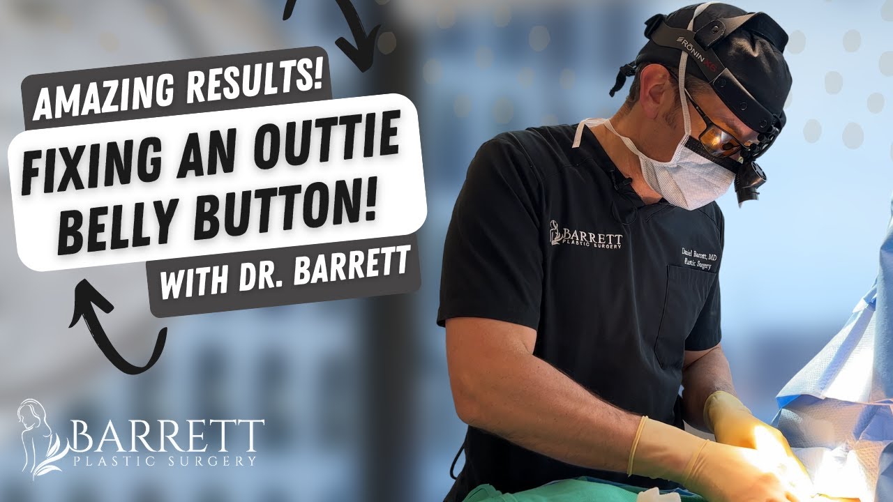 Turning An Outie Belly Button Into An Innie! | Barrett Plastic Surgery ...