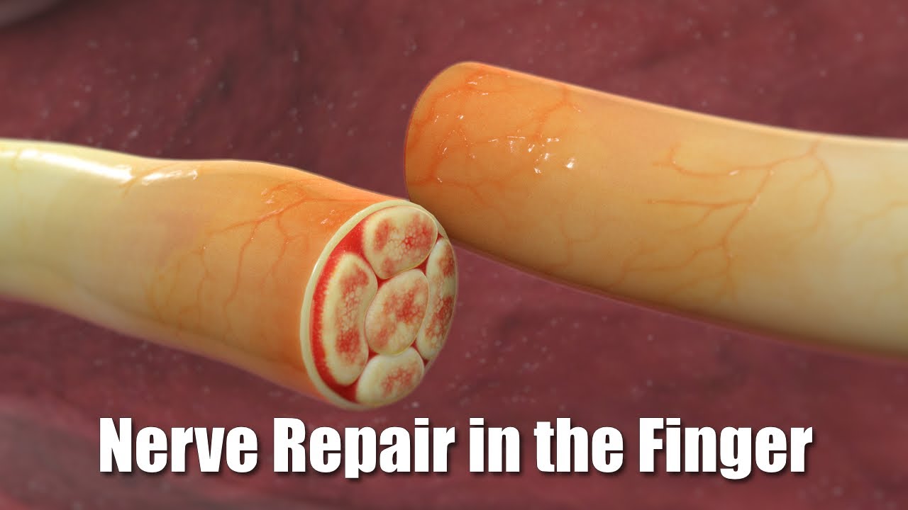 Nerve Repair in the Finger - YouTube