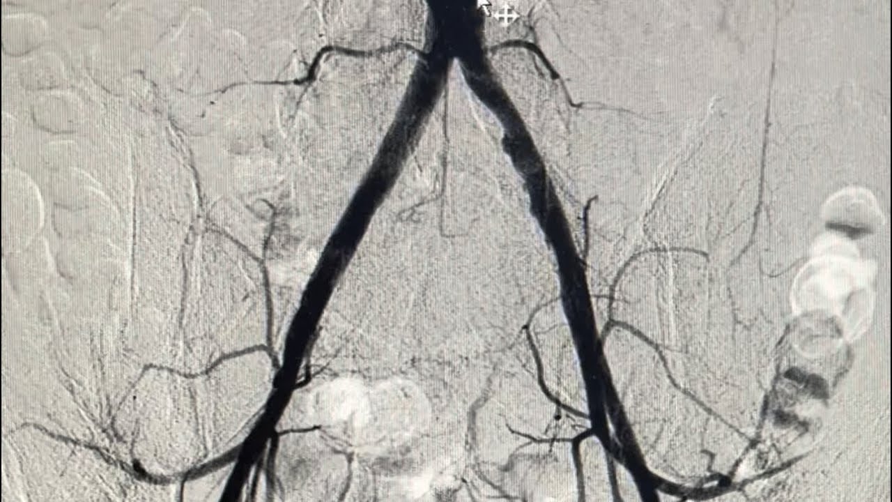 Angiographische Darstellung einer pAVK - YouTube