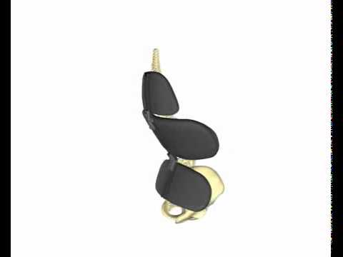 Lumbar Lordosis with anterior pelvic tilt - V-Trak hardware and Axxis ...