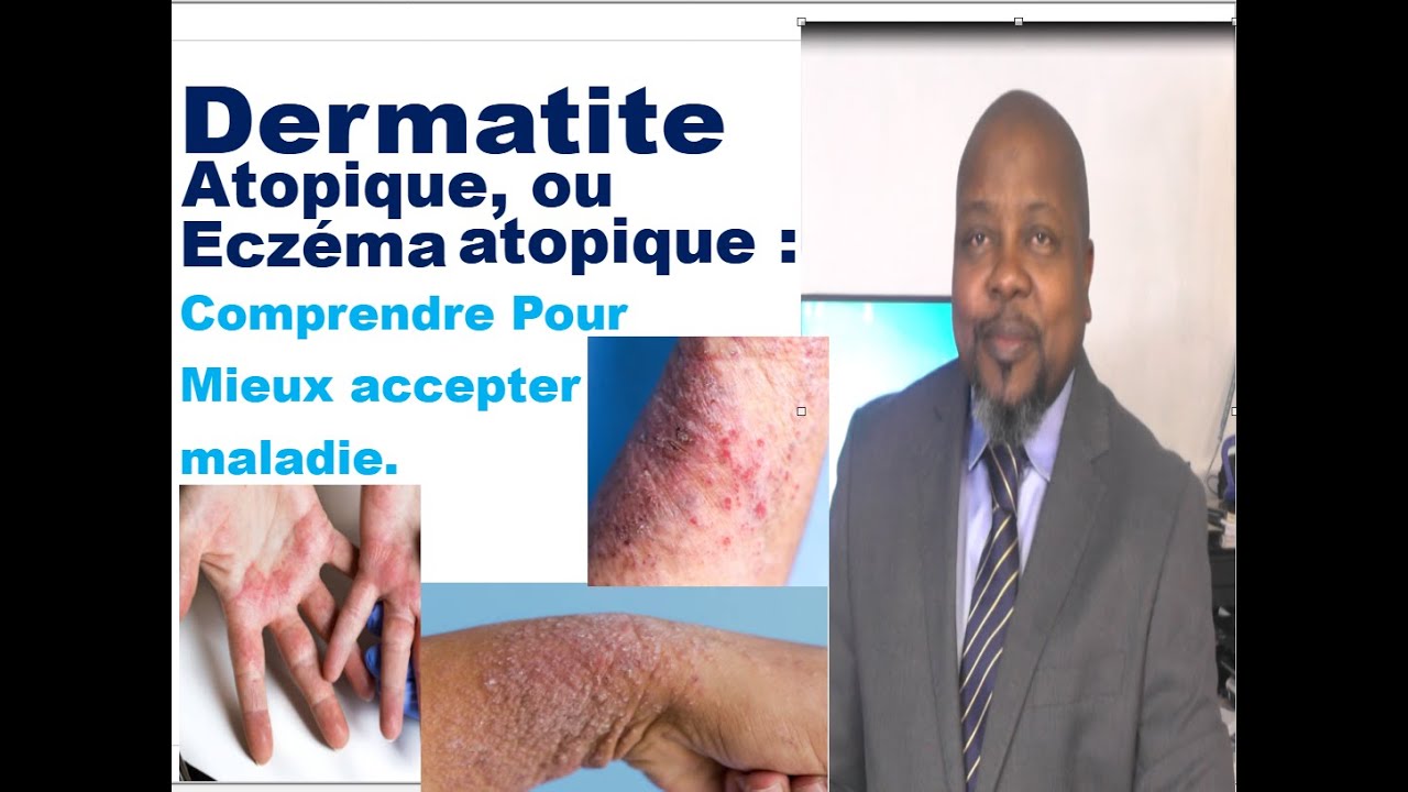 DERMATITE Atopique ou ECZÉMA Atopique: Comprendre pour mieux accepter ...
