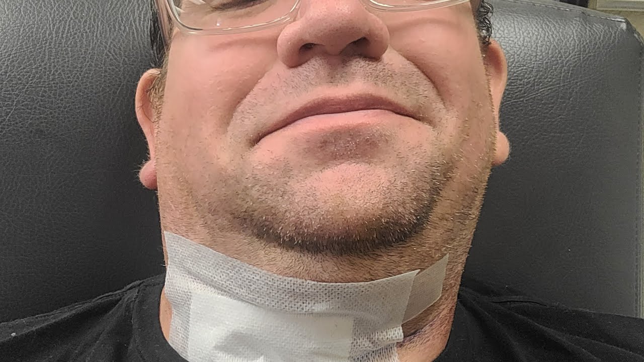 One Week Post ACDF Surgery - YouTube