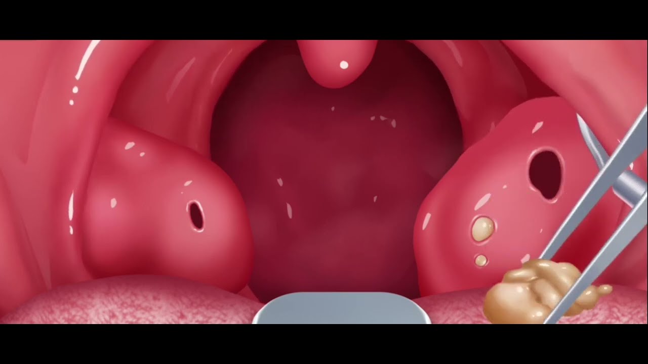 ASMR: Satisfying Patient Treatment Tonsil Stones removal for mood ...