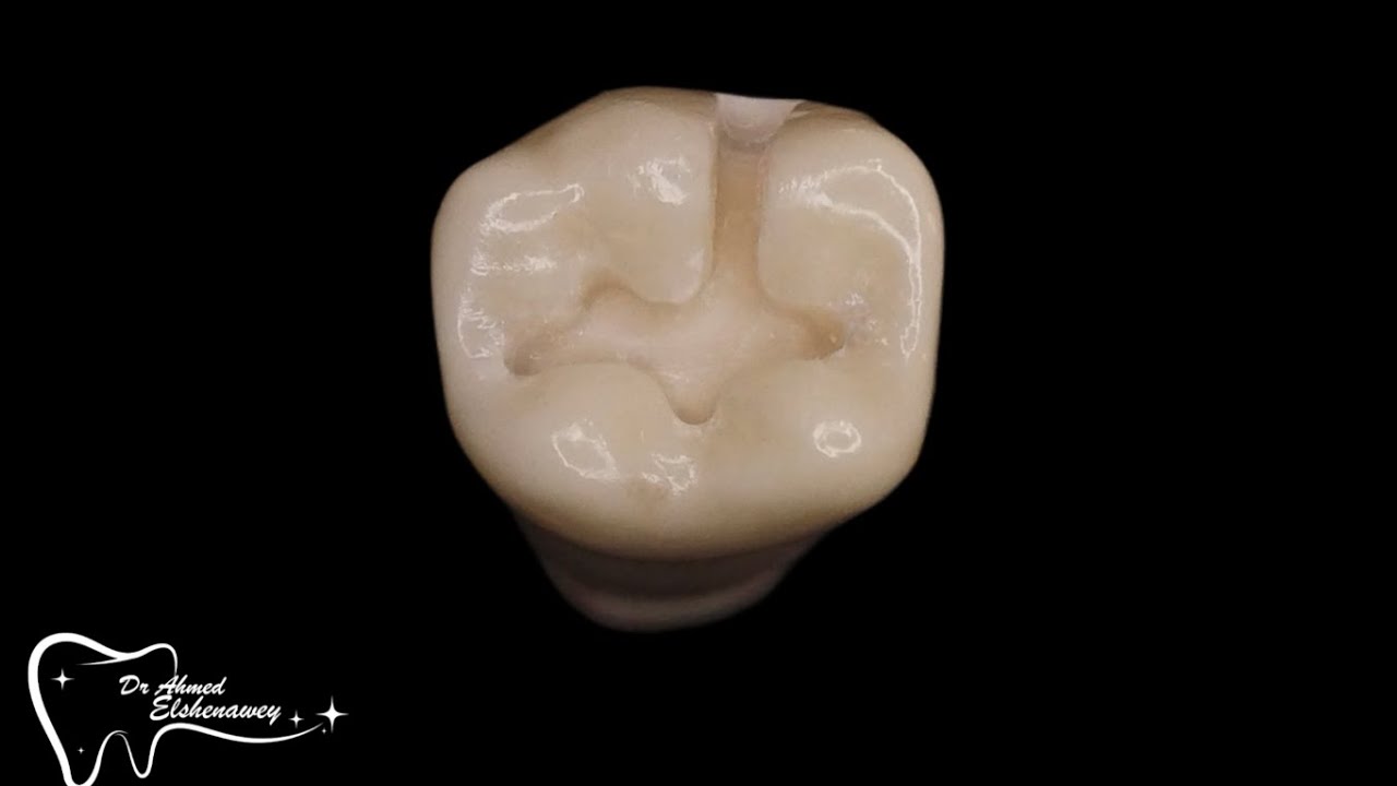 class 1 with buccal extension شرح عربي مفصل - YouTube