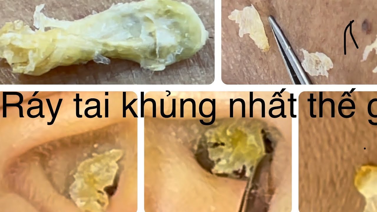 Ráy tai khủng nhất thế giới ,The world's biggest earwax - YouTube