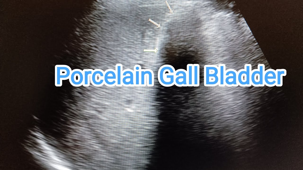 Porcelain Gall Bladder - YouTube