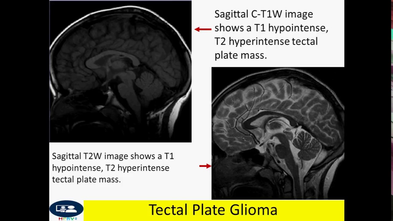 Tectal Plate Glioma - YouTube