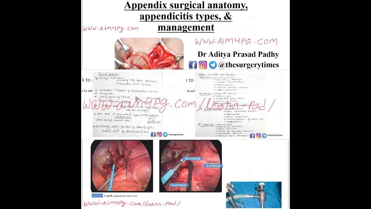 Appendicitis by Dr Aditya Prasad Padhy | AIM4PG - YouTube