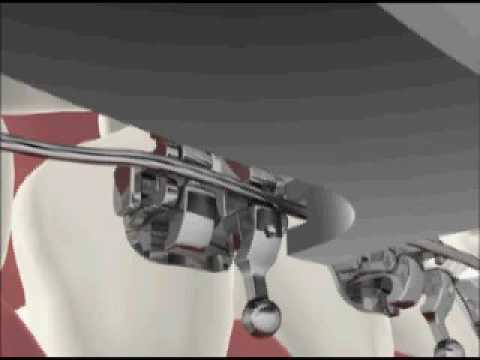 SmartClip™ Bracket Engagement Lower Arch - YouTube