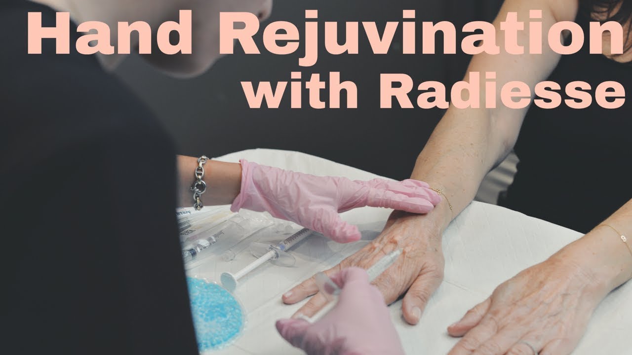 Hand Rejuvenation With Radiesse Filler - YouTube