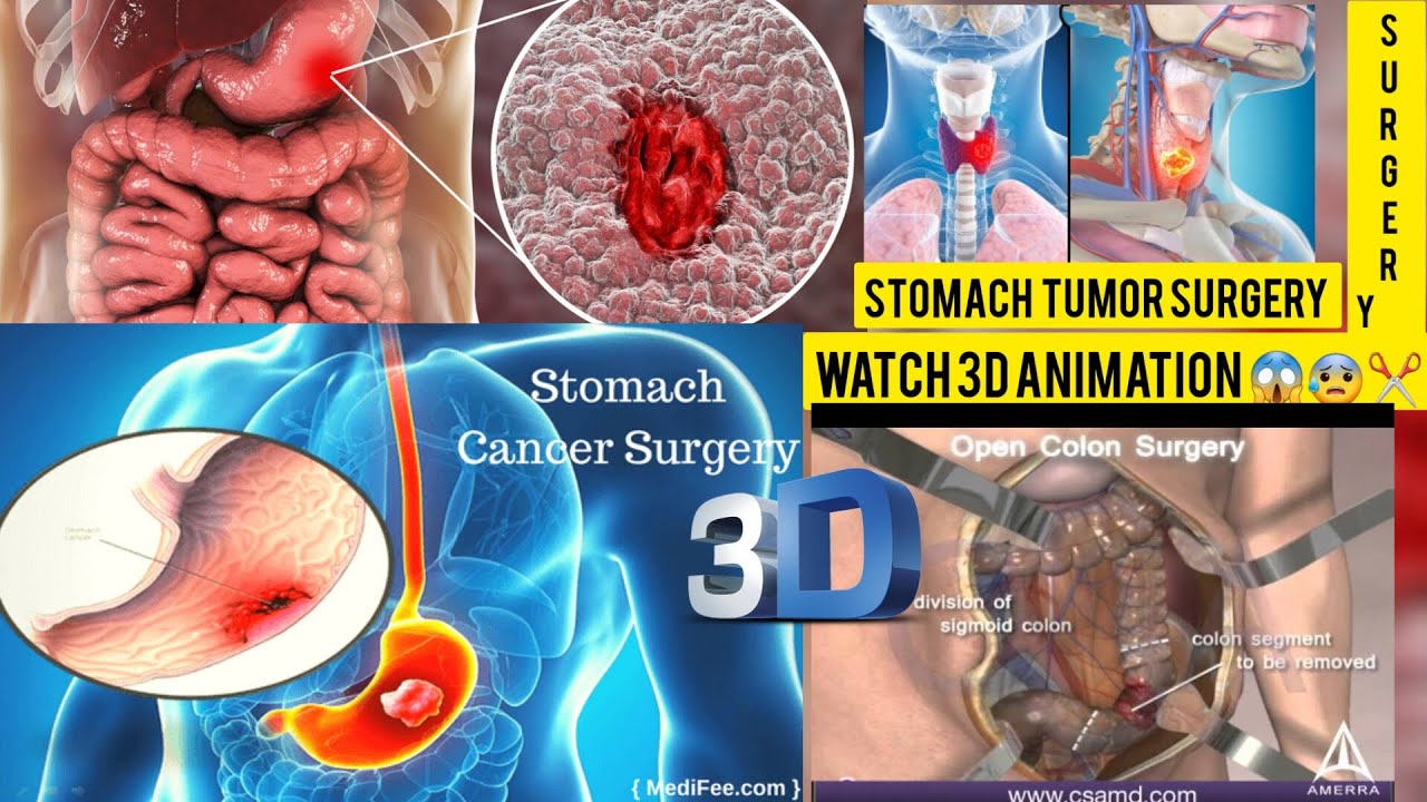 ️😱STOMACH TUMOR OPERATION《😰3D ANIMATION》#viral#anotomy#youtube # ...