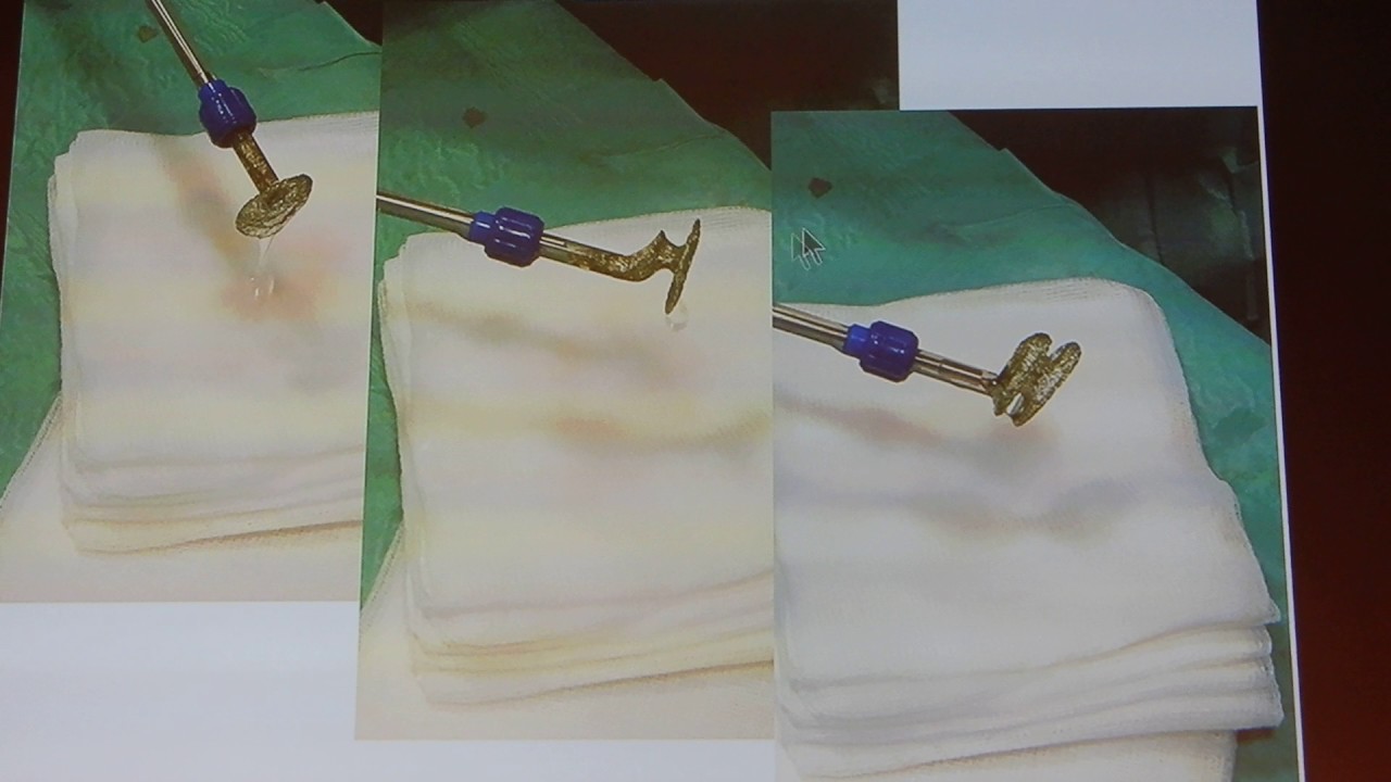 Interatrial Shunting for HF - Recorded Case AFR - Device Therapies for ...