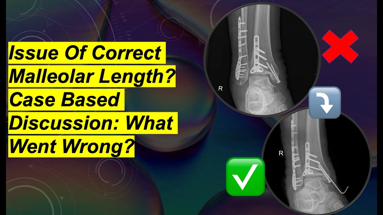 Issue of Fibular Shortening in Ankle/Malleolar fractures: Case Based ...