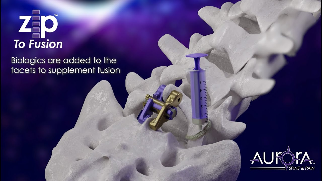zip™ to Fusion! Aurora Spine & Pain - YouTube