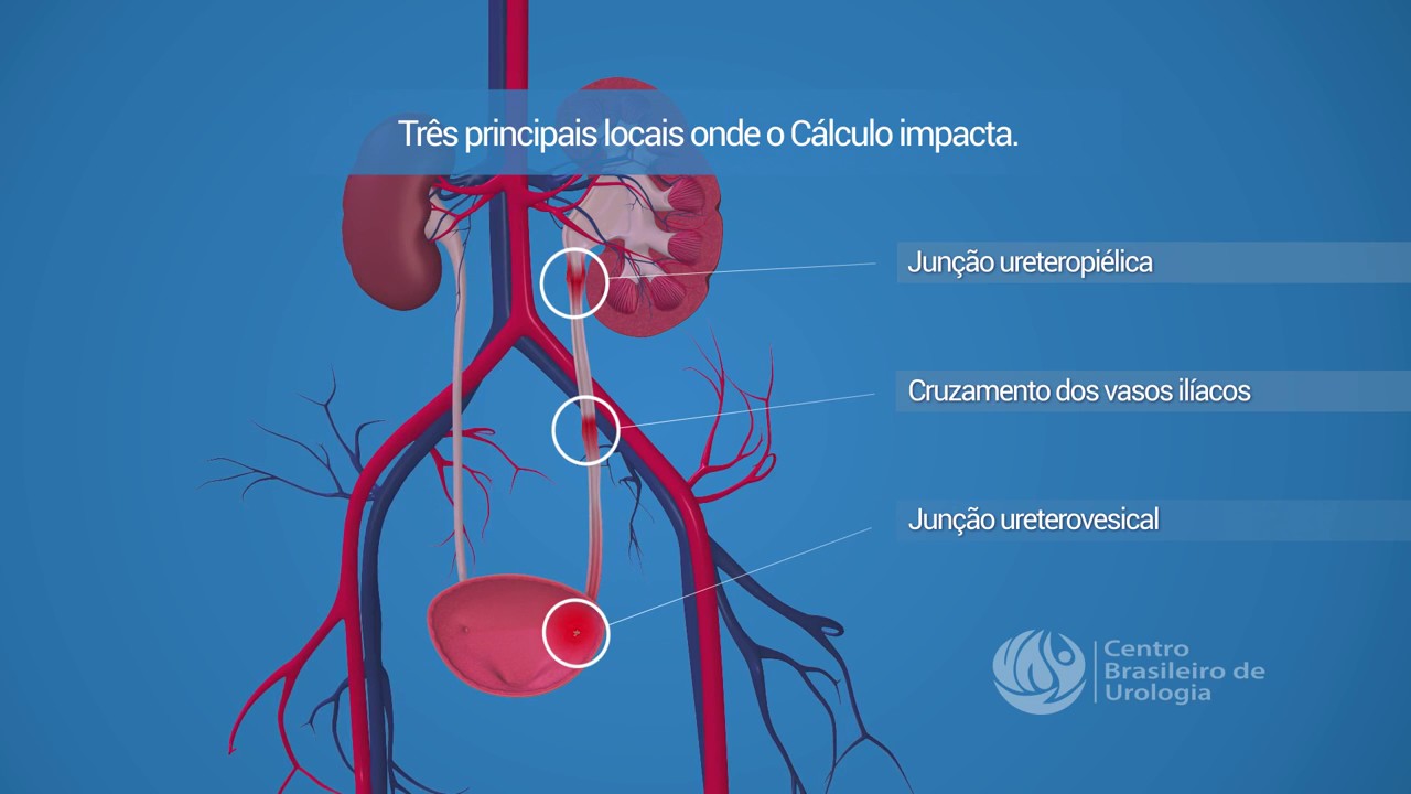 Cálculo Na Junção Ureterovesical Direita - RETOEDU