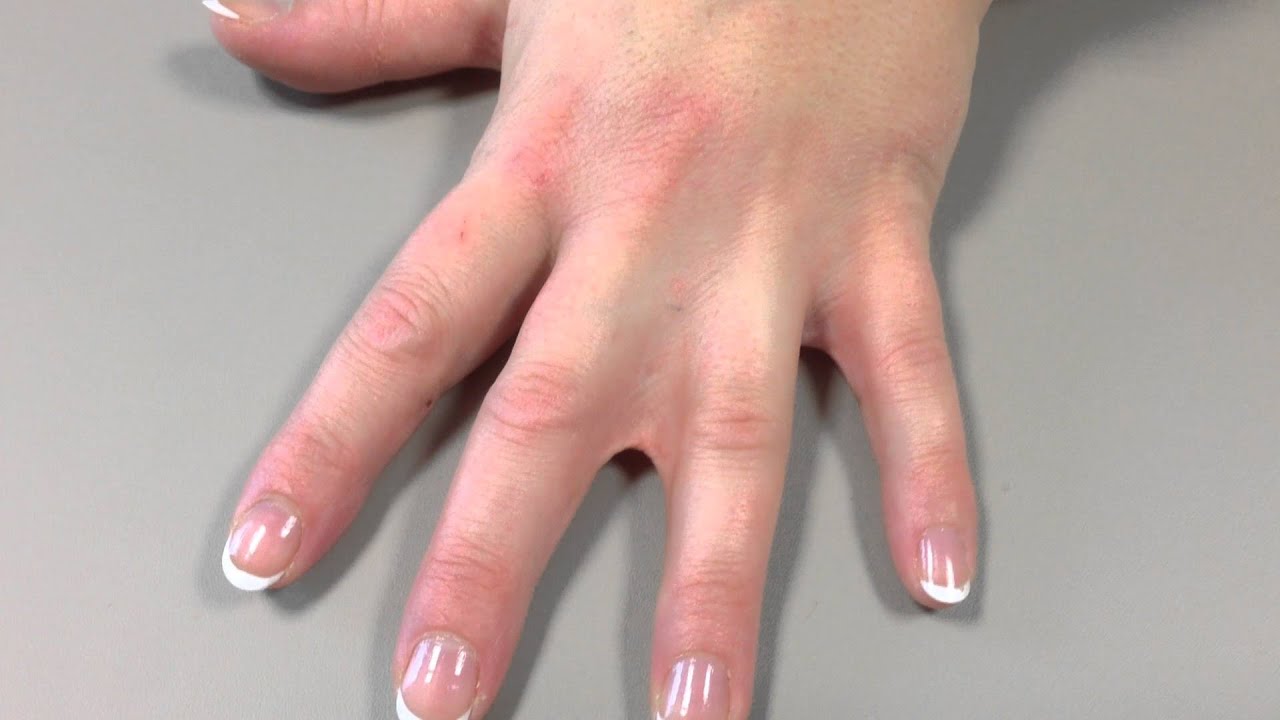 syndactylie digitale par le docteur Gueguen - YouTube