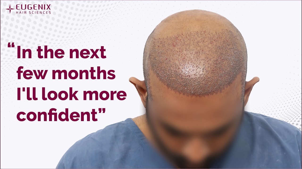 Hair Transplant – Now A Smooth Procedure - YouTube
