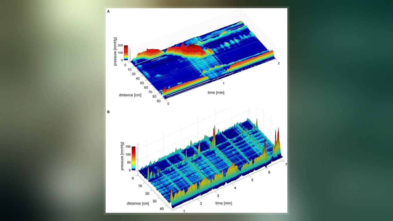 Rectoanal Inhibitory Reflex - YouTube