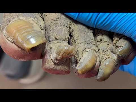 Clean Your Grandpa's Feet! Clean The Black Dead Skin【Xue Yidao】