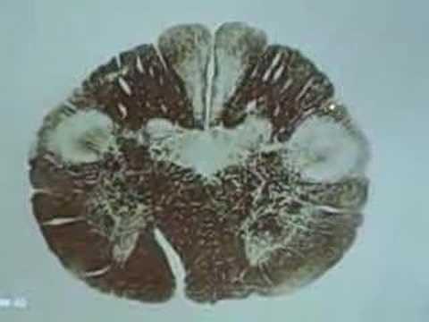Lower Medulla (Decussation of the pyramids) - YouTube