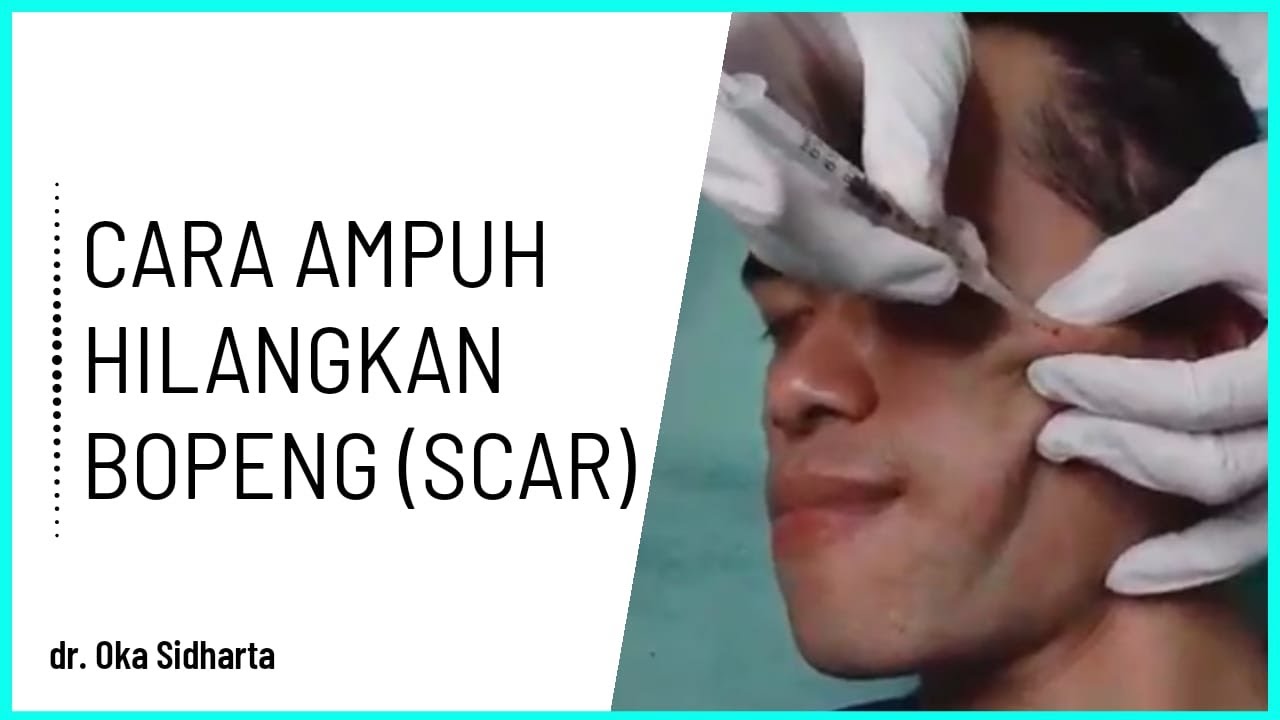 Cara AMPUH hilangkan bopeng (scar) | Edukasi Series | by dr. Oka ...