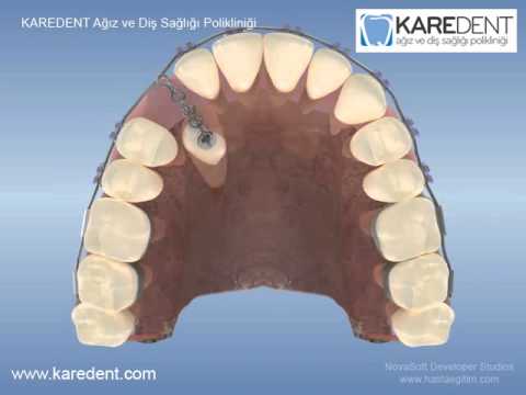 gömülü köpek dişinin sürdürülmesi