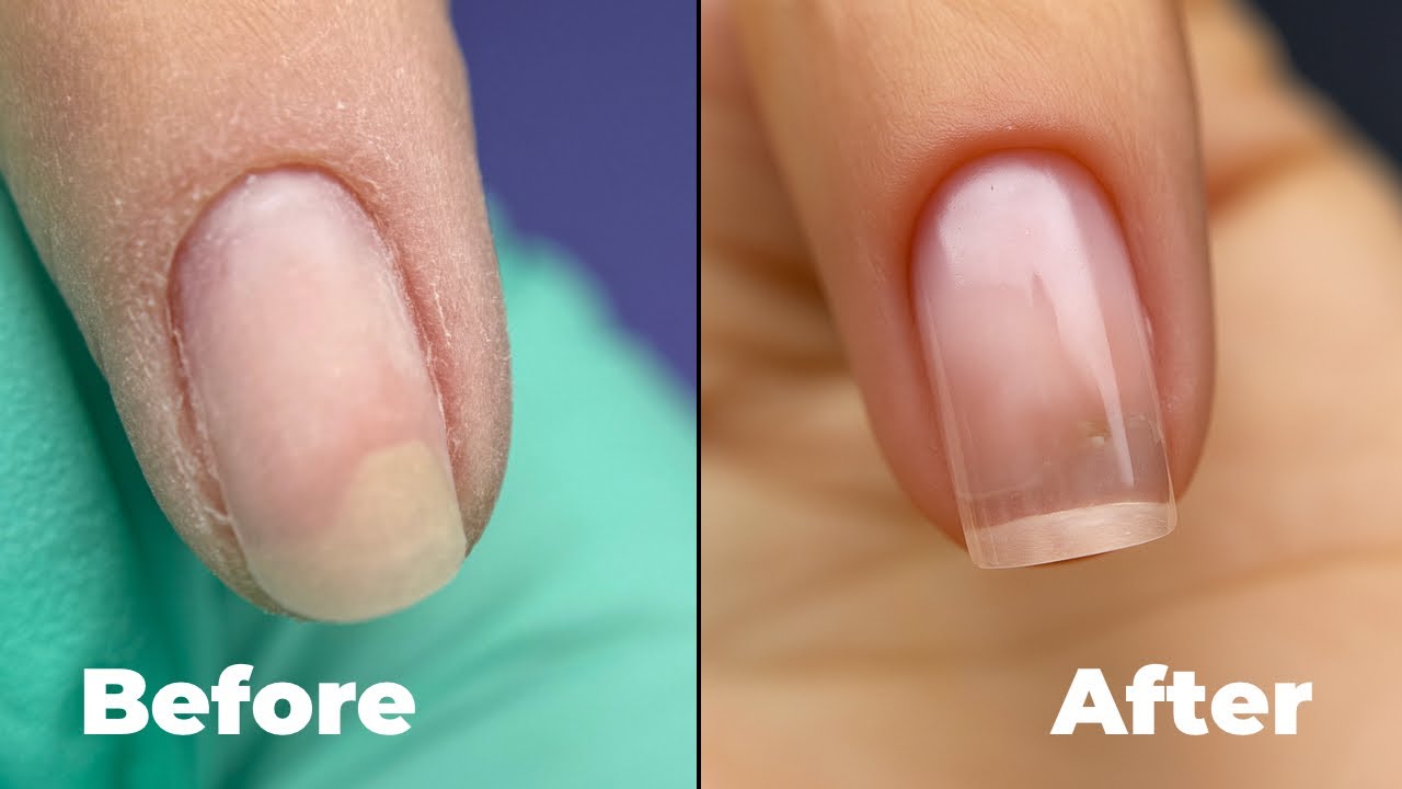 How I Repair Severe Onycholysis Nails Using Fiberglass & Builder Gel ...