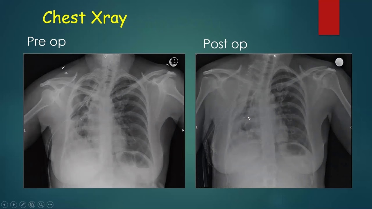 Thoracoplasty - YouTube