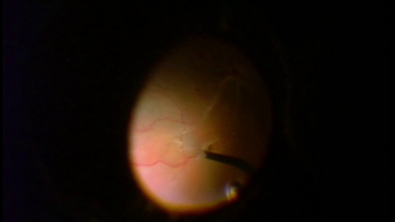 25 gauge Vitrectomy for Repair of Complete Retinal Detachment | Randall ...