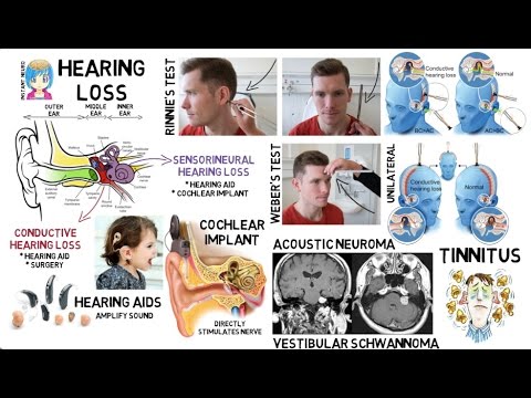 INSTANT NEURO - Hearing loss - YouTube