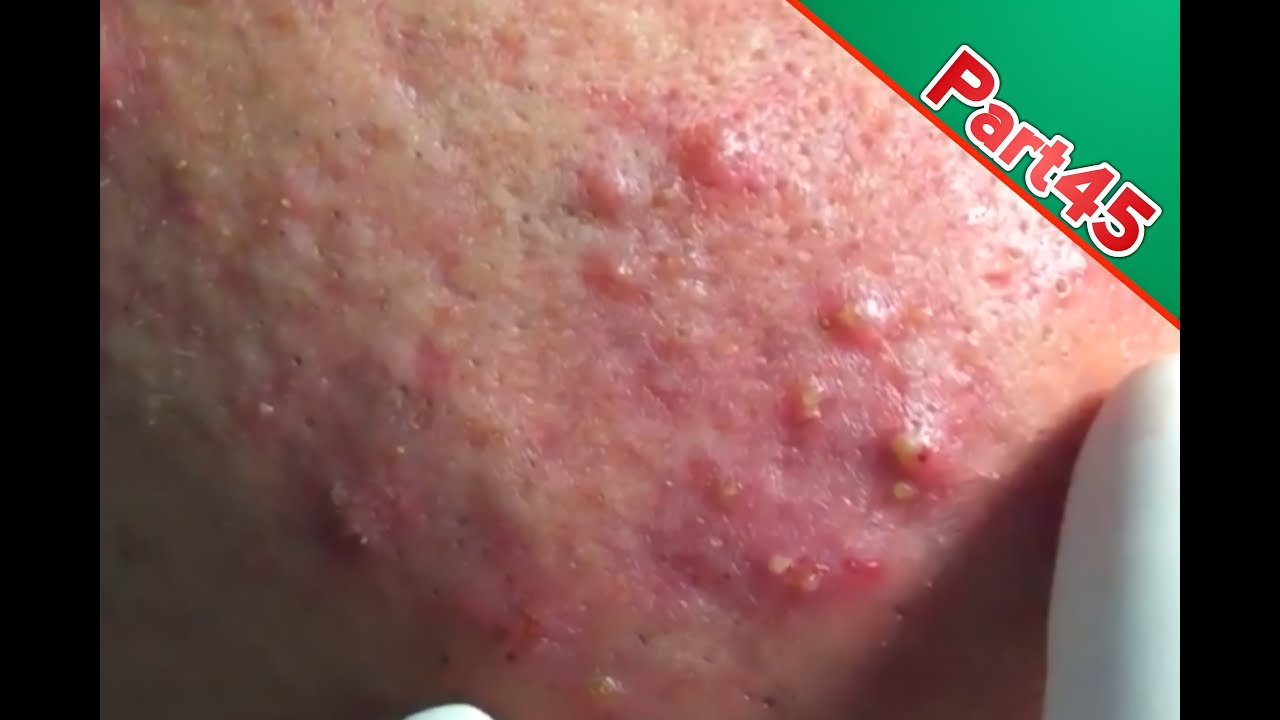 PART45-Relaxing Big Acne Inflamed Awesome Popping-Top skin care - YouTube