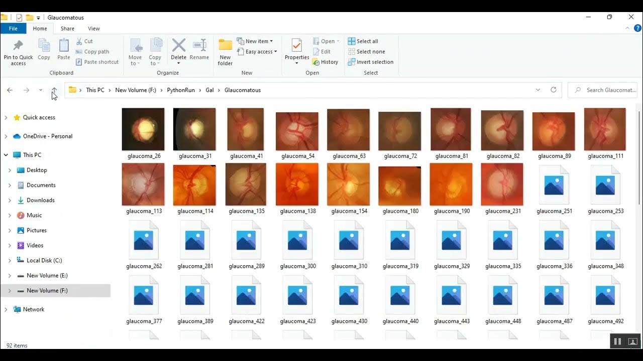 Glaucoma detection in fundus image using CNN - YouTube