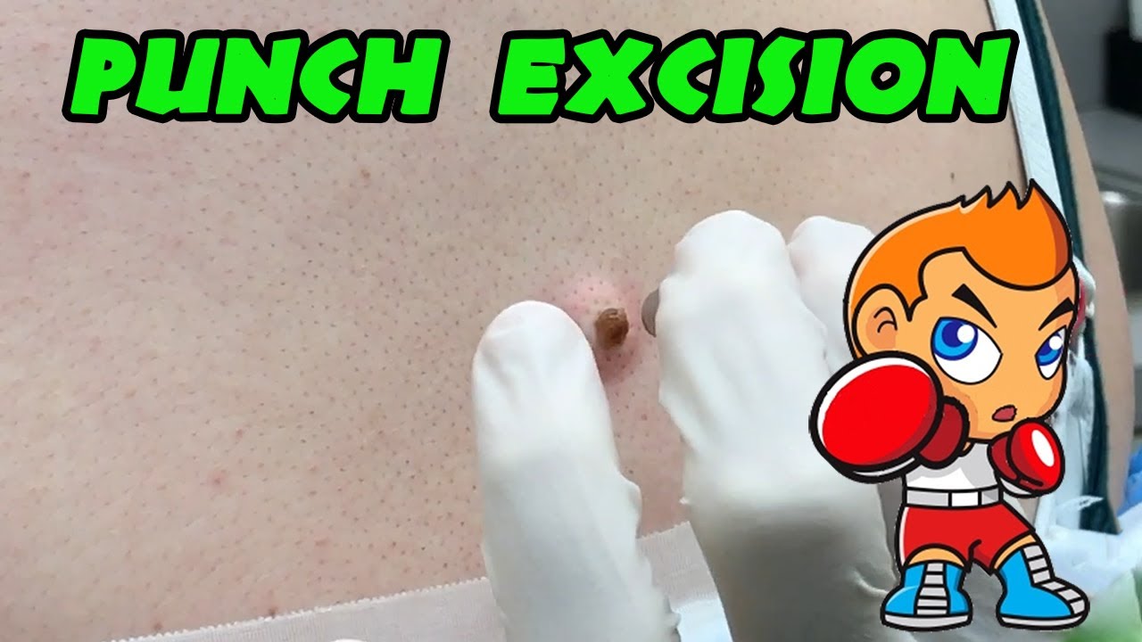 Nevus Punch Excision! POW - YouTube