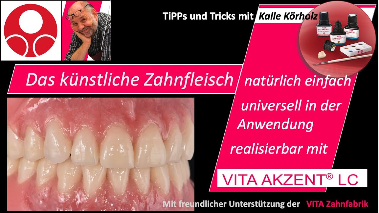 Das künstliche Zahnfleisch individualisieren mit VITA Akzent LC - YouTube
