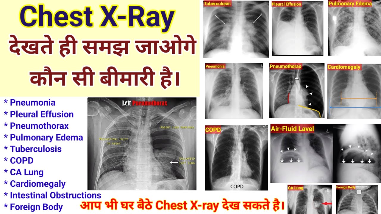 How to read a chest X-ray # Pneumonia # Lungs effusion # TB # CA lungs # Pneumothorax # COPD # ...