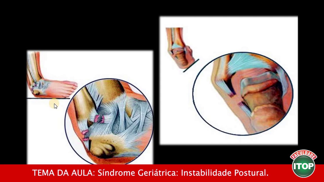 ENFERMAGEM - SÍNDROME GERIÁTRICA: INSTABILIDADE POSTURAL - Faculdade ...