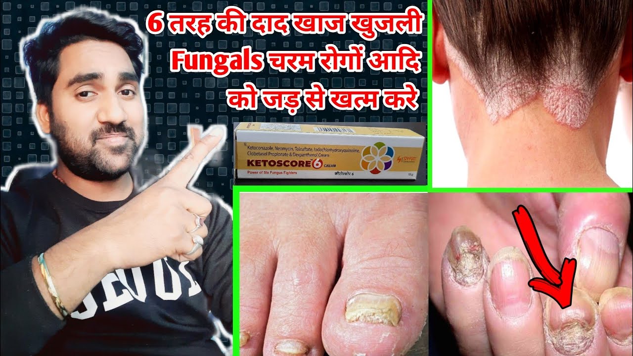 नाखून में होने वाली Fungus और दाद आदि को जड़ से ठीक करे ! Ketoscore 6 ...
