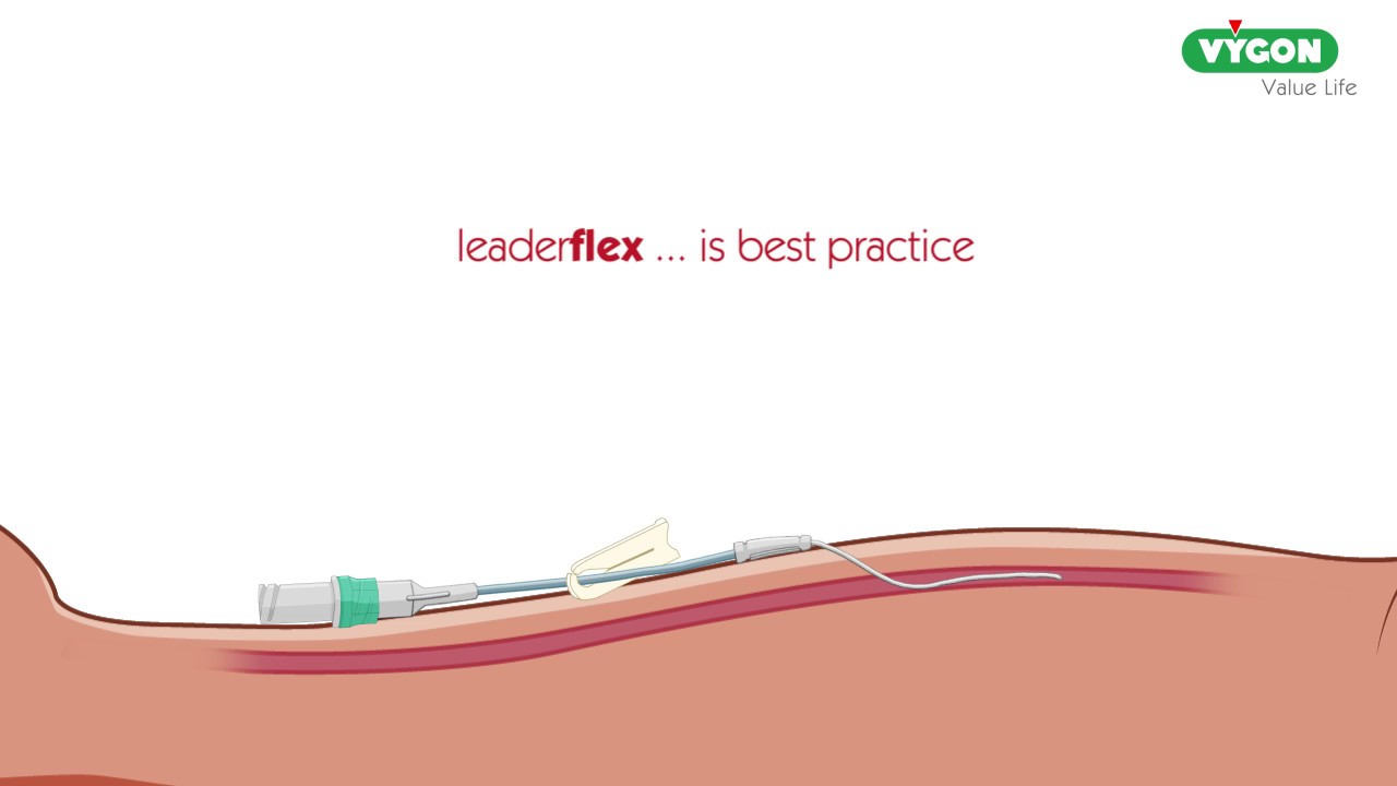 Leaderflex Insertion Technique - YouTube