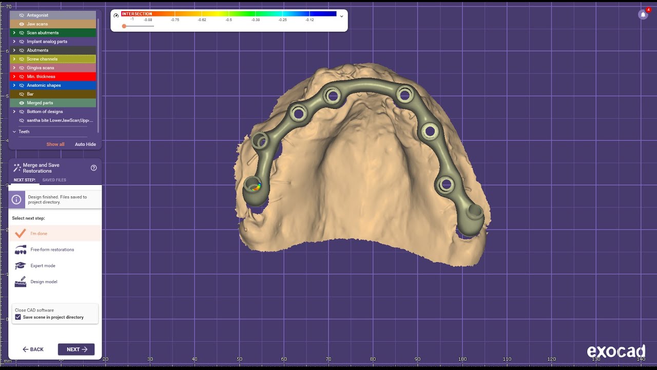 HOW TO DESIGN - Upper titanium bar designing for compressive multiunit ...