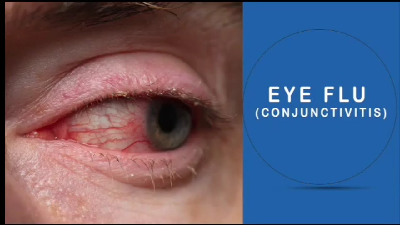 Eye Flu (Conjunctivitis) Awareness Video - YouTube