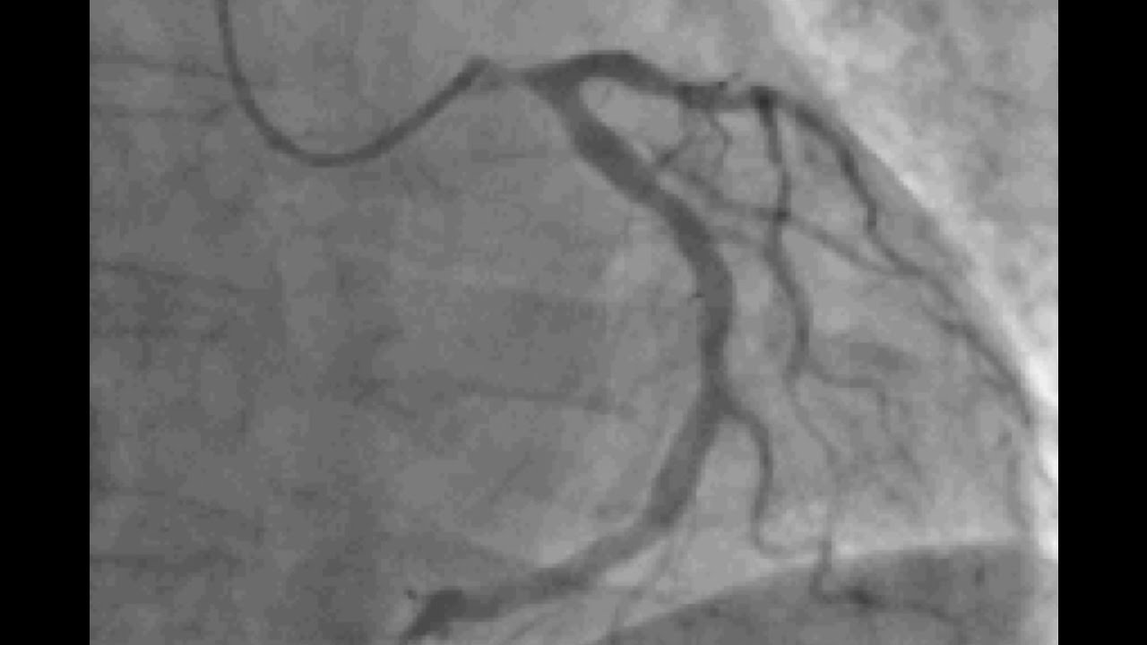 Left Main NSTEMI - YouTube