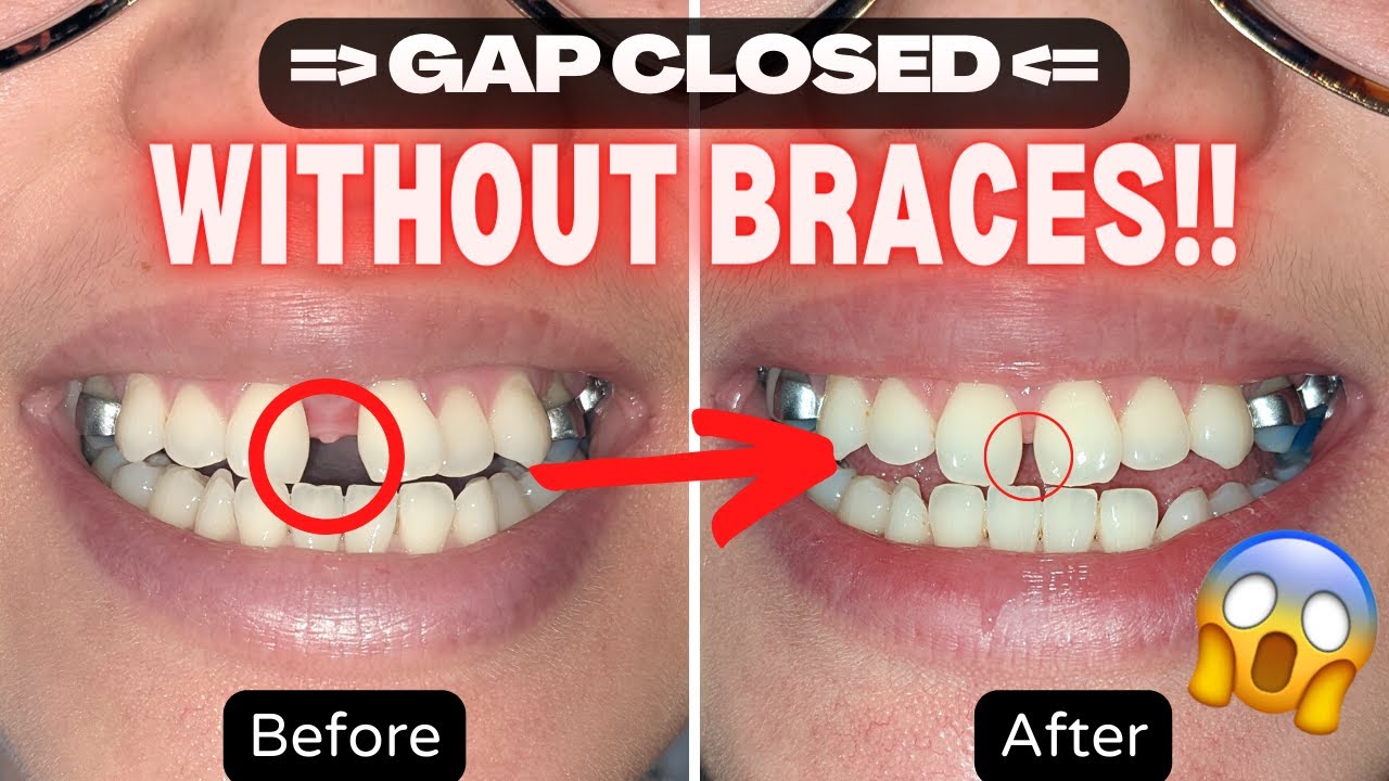 SARPE Palatal Expansion Gap Closure TIME LAPSE YouTube SARPE Palatal Expansion Gap Closure TIME LAPSE YouTube