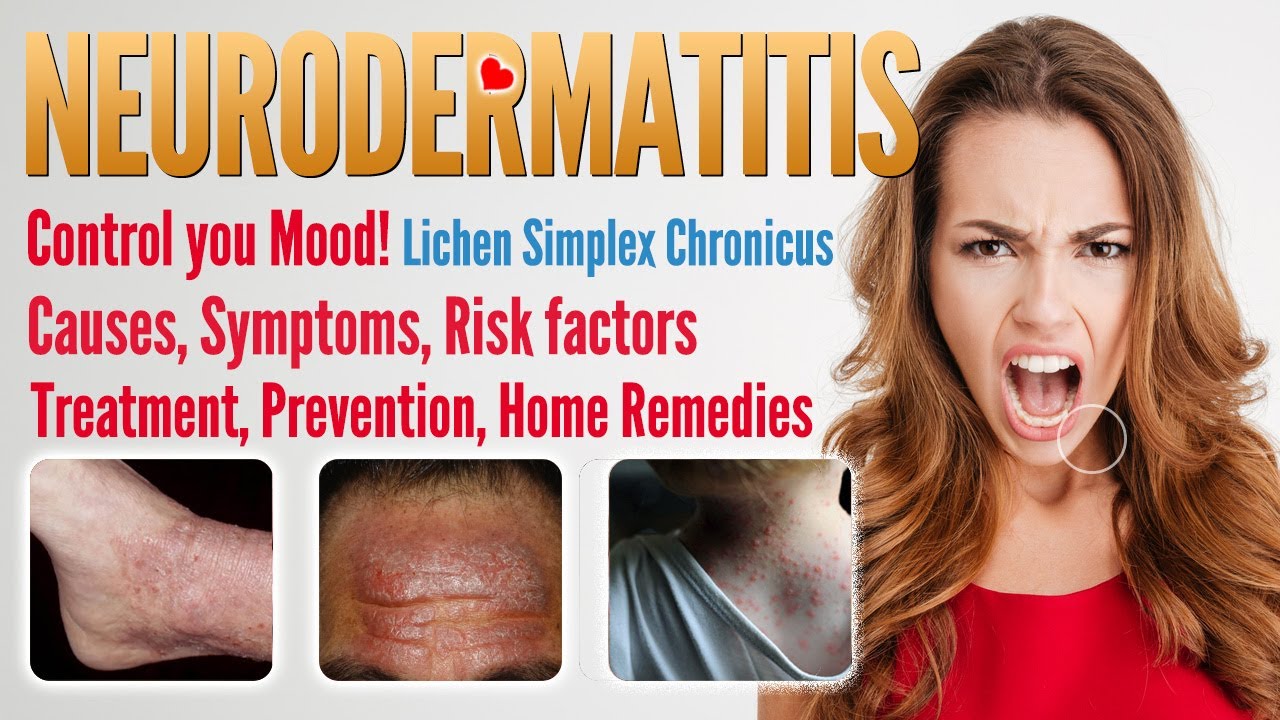 Neurodermatitis Causes, Symptoms, Treatment, Prevention and Home ...