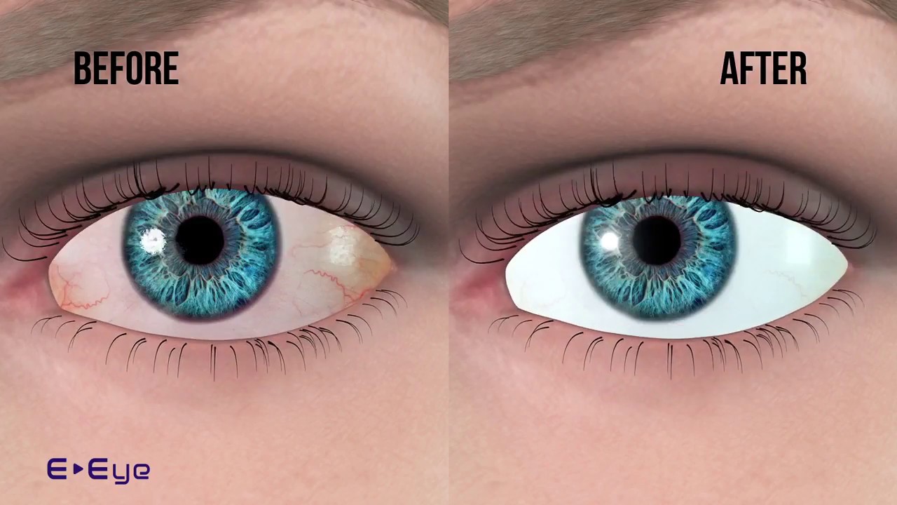 E-EYE Operating mechanism - YouTube