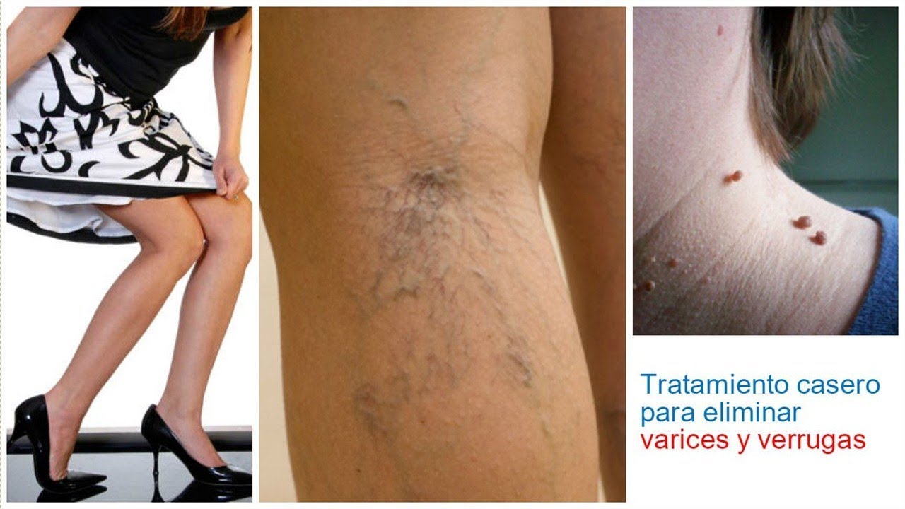 Tratamiento Casero Para Las Varices 🖖 Varices Internas Remedios Caseros ...