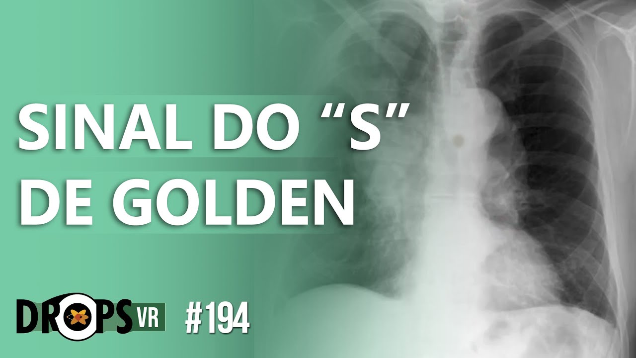 SINAL DO “S” DE GOLDEN - YouTube