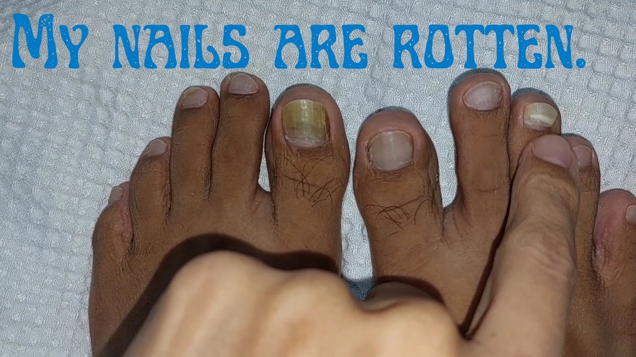 My nails are rotten. Part 1. - YouTube