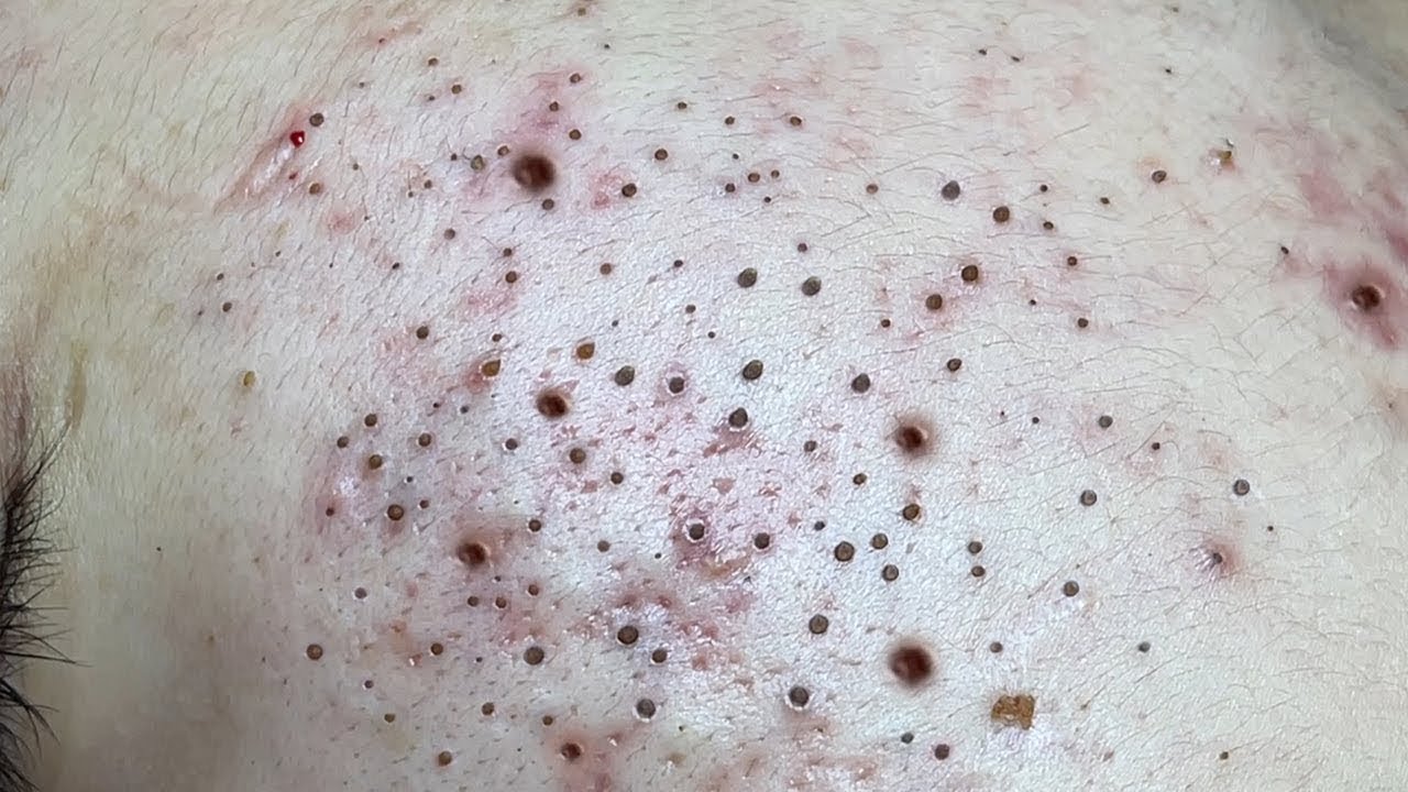 𝐄𝐱𝐭𝐫𝐞𝐦𝐞 𝐁𝐥𝐚𝐜𝐤𝐡𝐞𝐚𝐝 𝐑𝐞𝐦𝐨𝐯𝐚𝐥 𝐚𝐭 𝐍𝐚𝐒𝐚 𝐒𝐤𝐢𝐧 𝐂𝐚𝐫𝐞 #𝟏𝟐𝟓 - YouTube