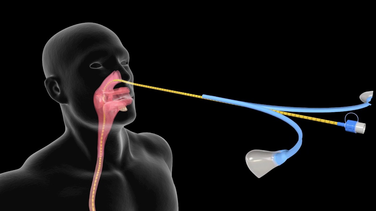 PatCom Introducer for safe and comfortable placement of NG-tubes, HRM ...